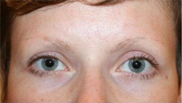 Scales on the eyebrows, eyebrows itchy and falling out : Causes and ...