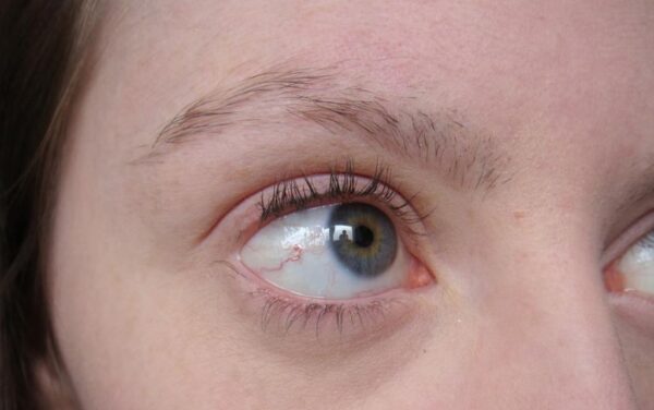 Scales on the eyebrows, eyebrows itchy and falling out : Causes and ...