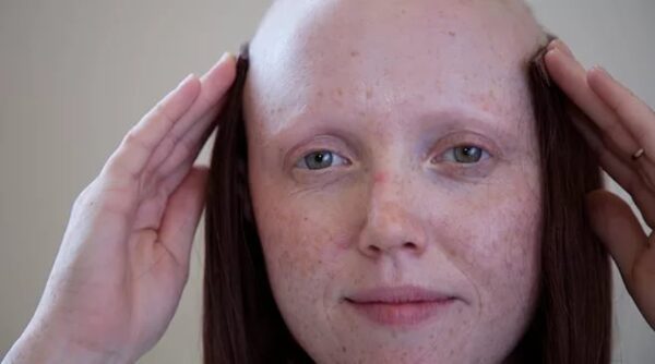 Scales on the eyebrows, eyebrows itchy and falling out : Causes and ...