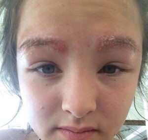 Why itchy eyebrows: causes and treatment