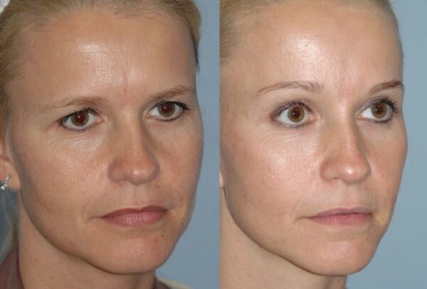 An endoscopic brow lift and a temporal brow lift What are the choices ...