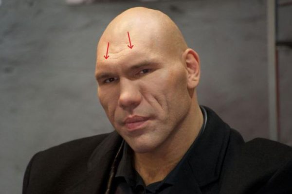 Protruding brow - what does it mean?