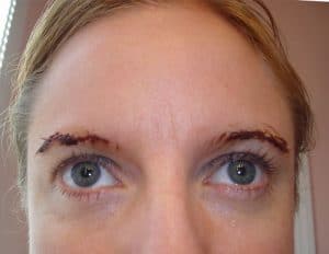 How to treat allergic reaction to eyebrow tint?