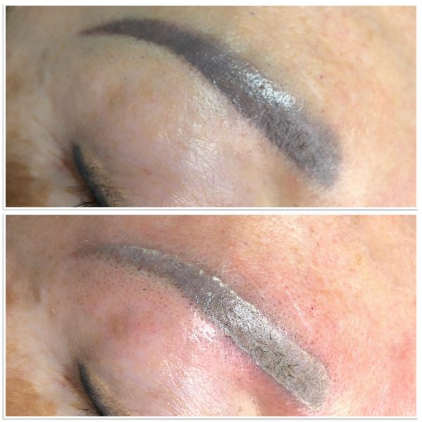 Microblading eyebrow removal