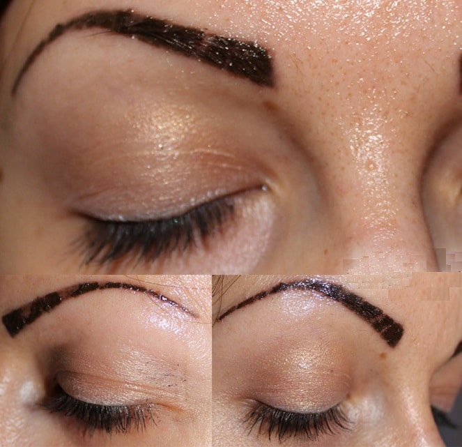 Eyebrow Tattoo Removal With and Without Laser