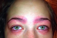 How to reduce swelling by eyebrow?