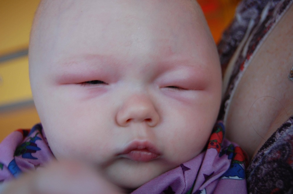 Toddler Woke Up With Swollen Eye: Causes, Treatment, and What to Do